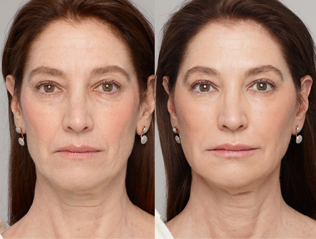 Lifting Techniques Brentwood CA & Manhattan NY | Goodskin