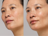 Botox Brentwood CA & Manhattan NY - Goodskin